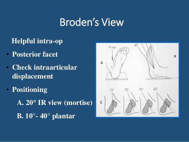 Calcaneal fractures --sito--29th aug 2015