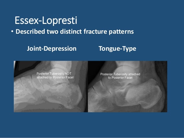 Calcaneal fractures --sito--29th aug 2015