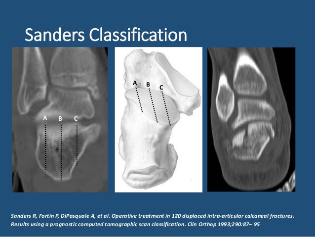 Calcaneal fractures --sito--29th aug 2015