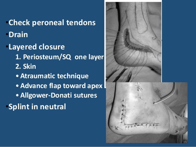 Calcaneal fractures --sito--29th aug 2015