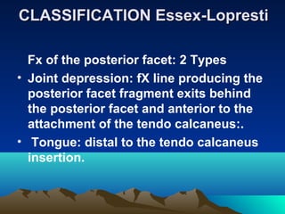 Calcaneal fractures new | PPT