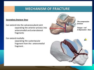 Calcaneal fractures new | PPT