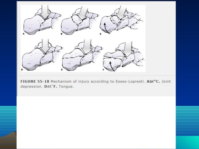Calcaneal fractures new