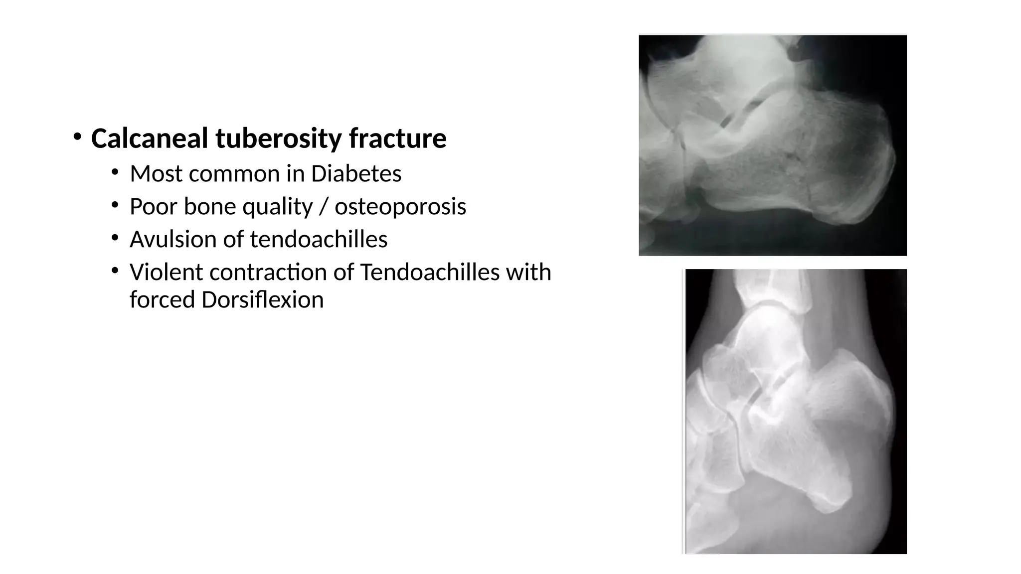 CALCANEAL FRACTURES PPT and JOURNAL.pptx