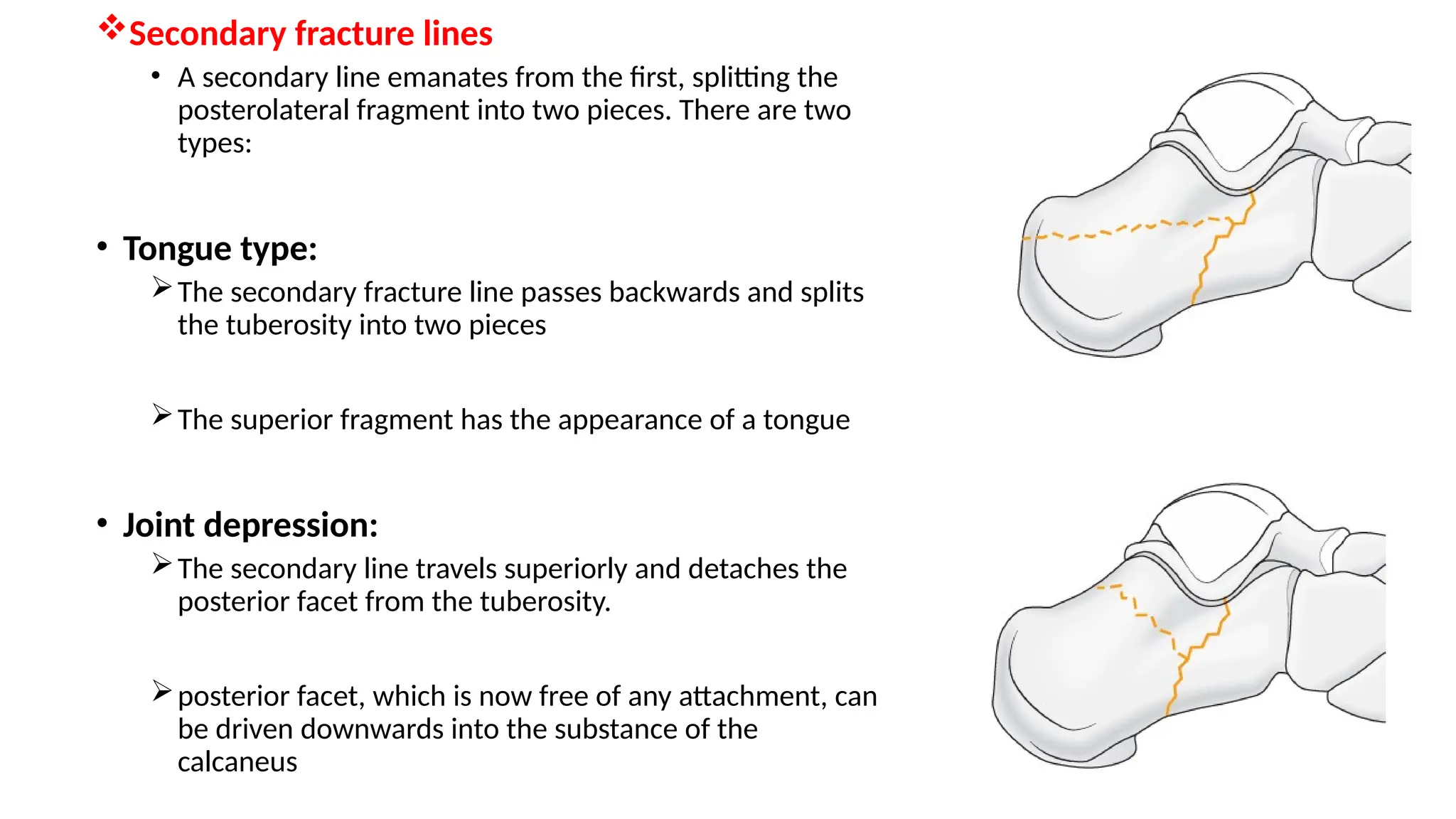 CALCANEAL FRACTURES PPT and JOURNAL.pptx