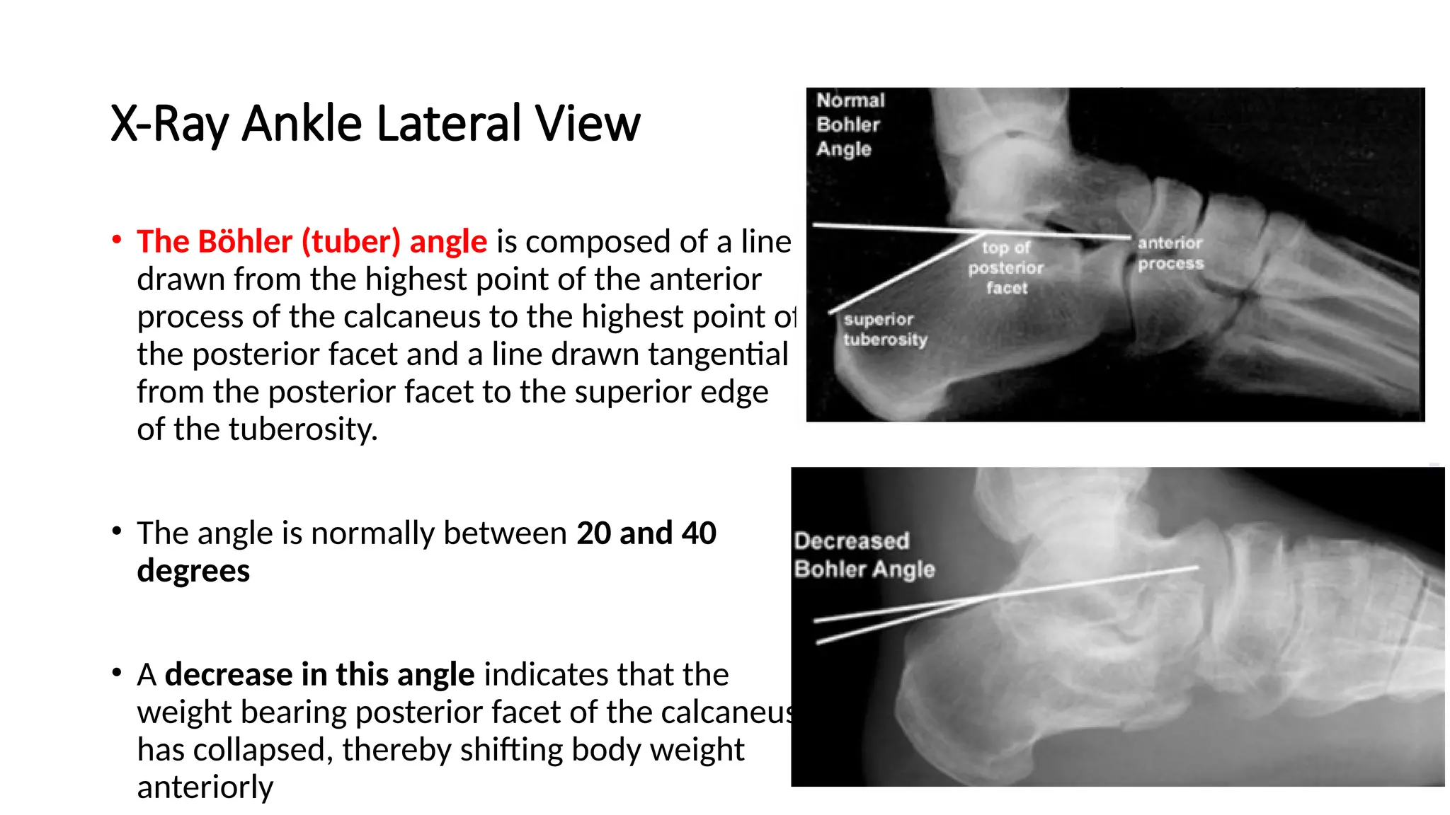 CALCANEAL FRACTURES PPT and JOURNAL.pptx