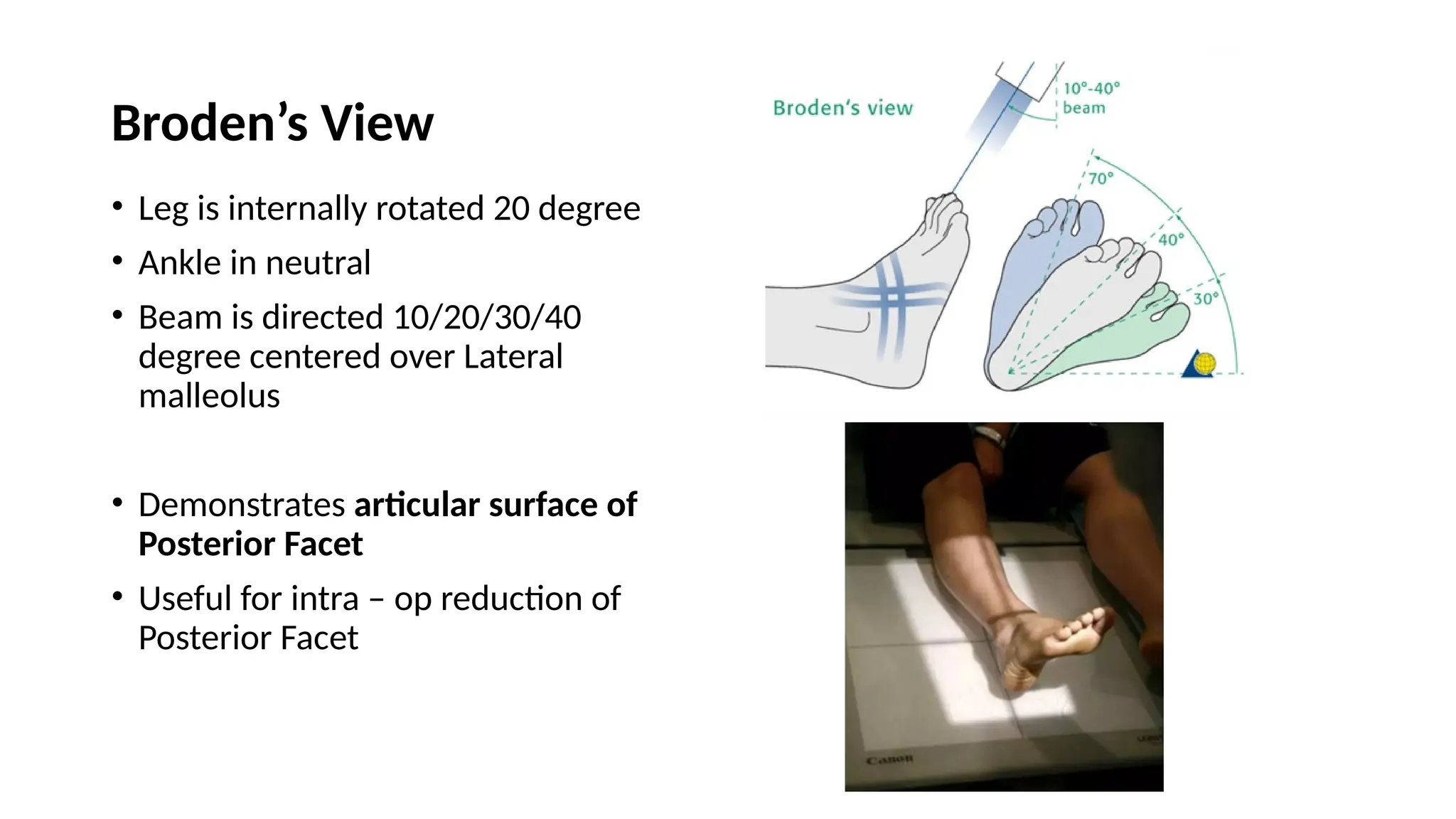 CALCANEAL FRACTURES PPT and JOURNAL.pptx