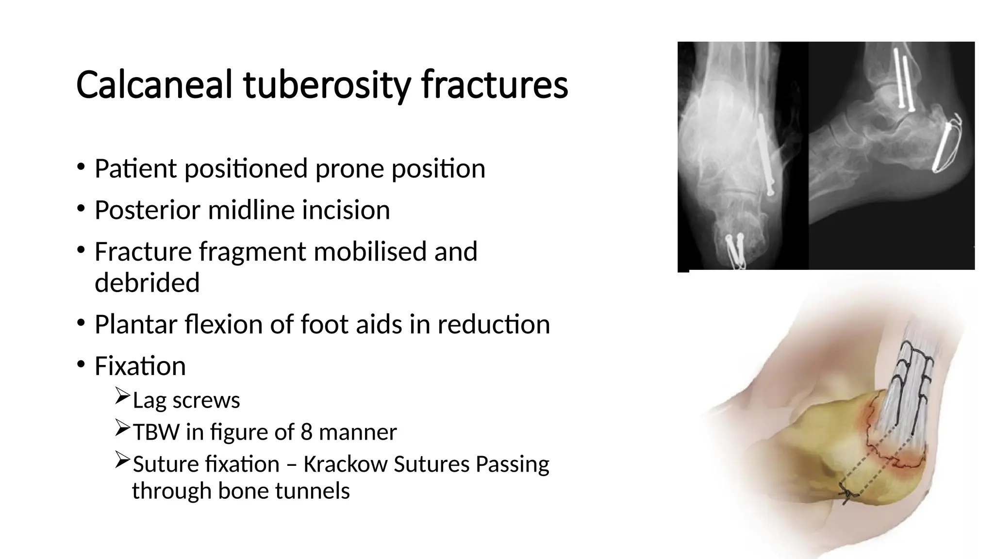 CALCANEAL FRACTURES PPT and JOURNAL.pptx