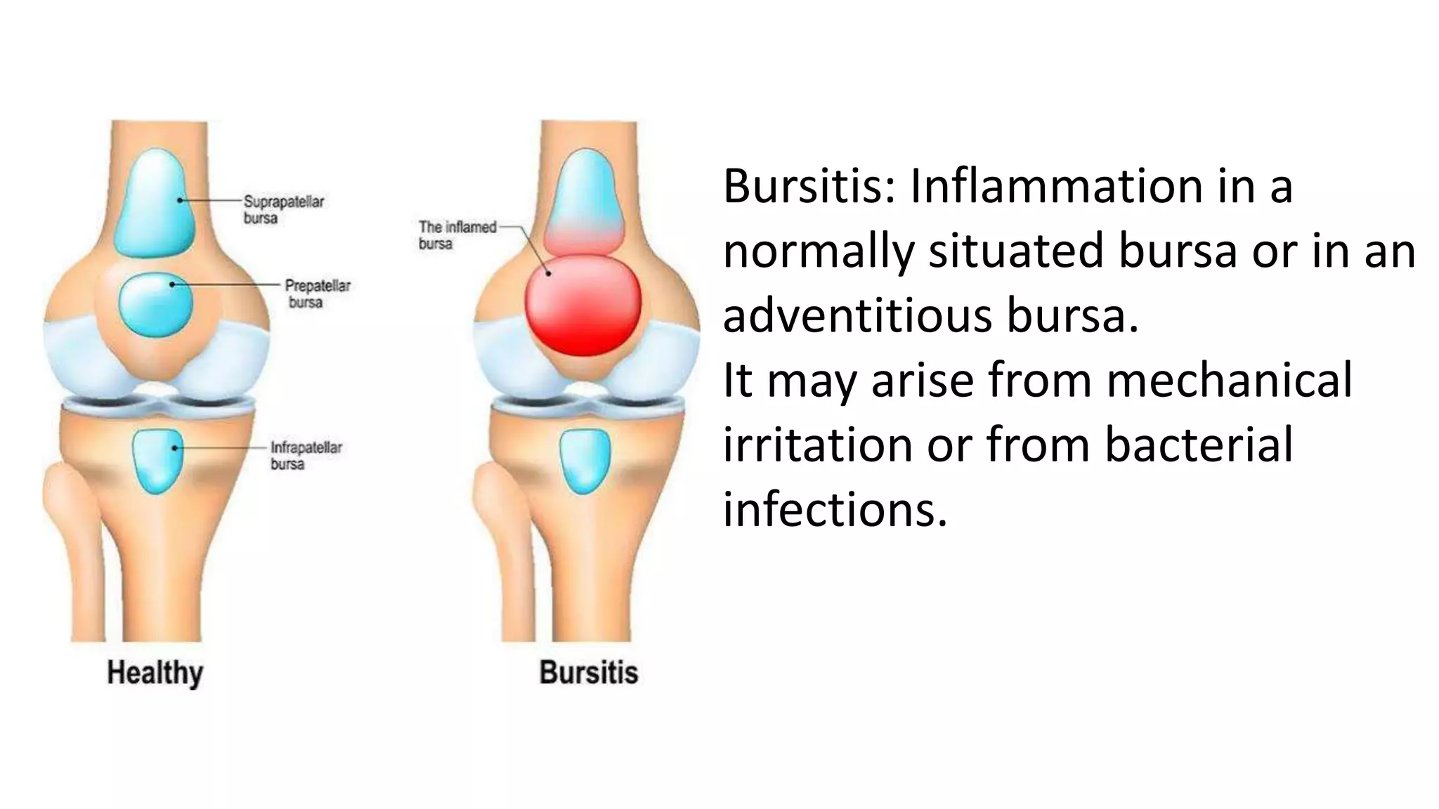 Calcaneal spur and chronic bursitis | PPTX