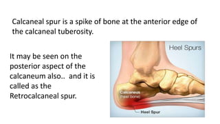 Retrocalcaneal Spur