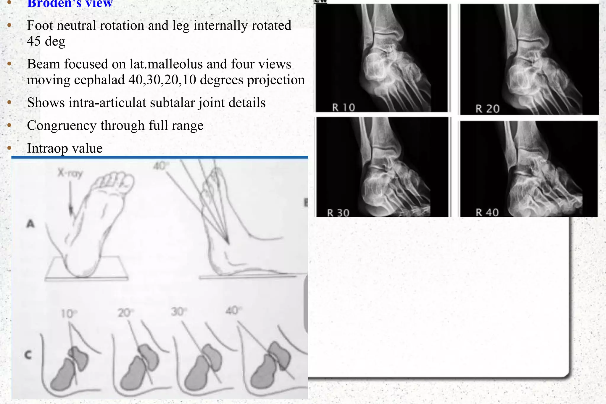 Calcaneum fractures | ODP