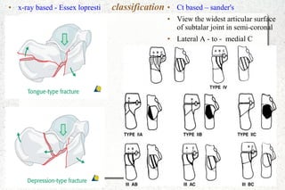 Calcaneum fractures | ODP