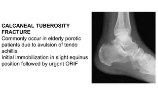 FRACTURES of CALCANEUS AND TALUS | PPTX
