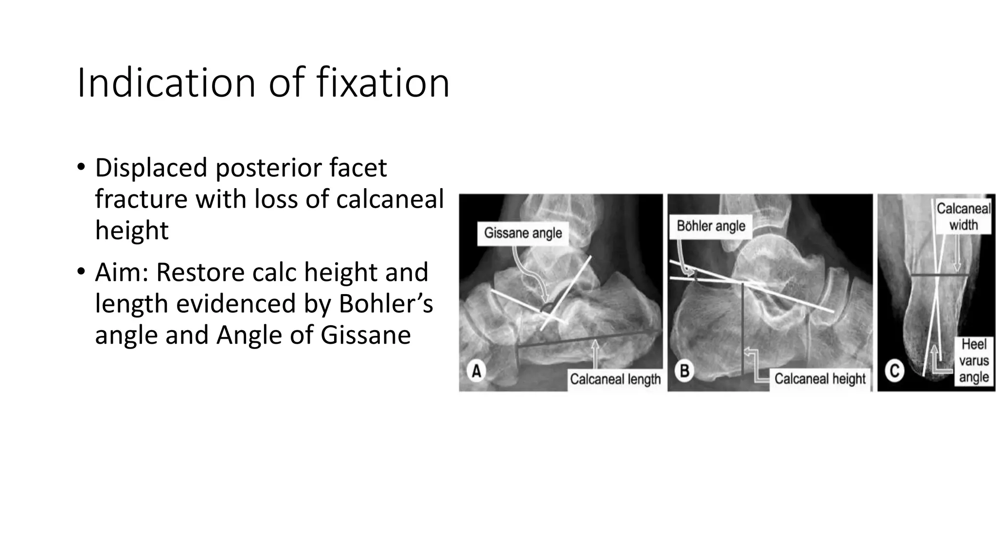 Calcaneum Fracture No touch Technique.pptx