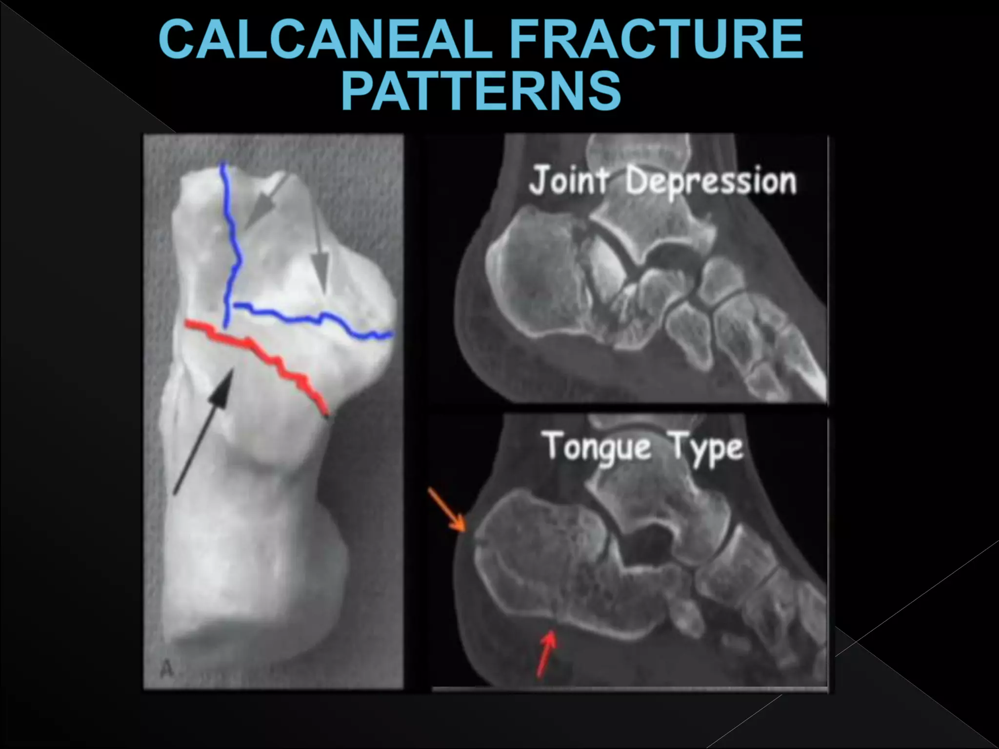 Calcaneum fractures | PPTX