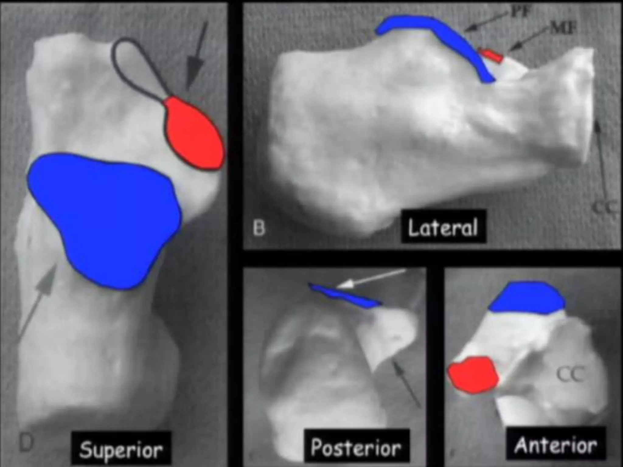 Calcaneum fractures | PPTX