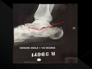 Calcaneum fractures | PPTX