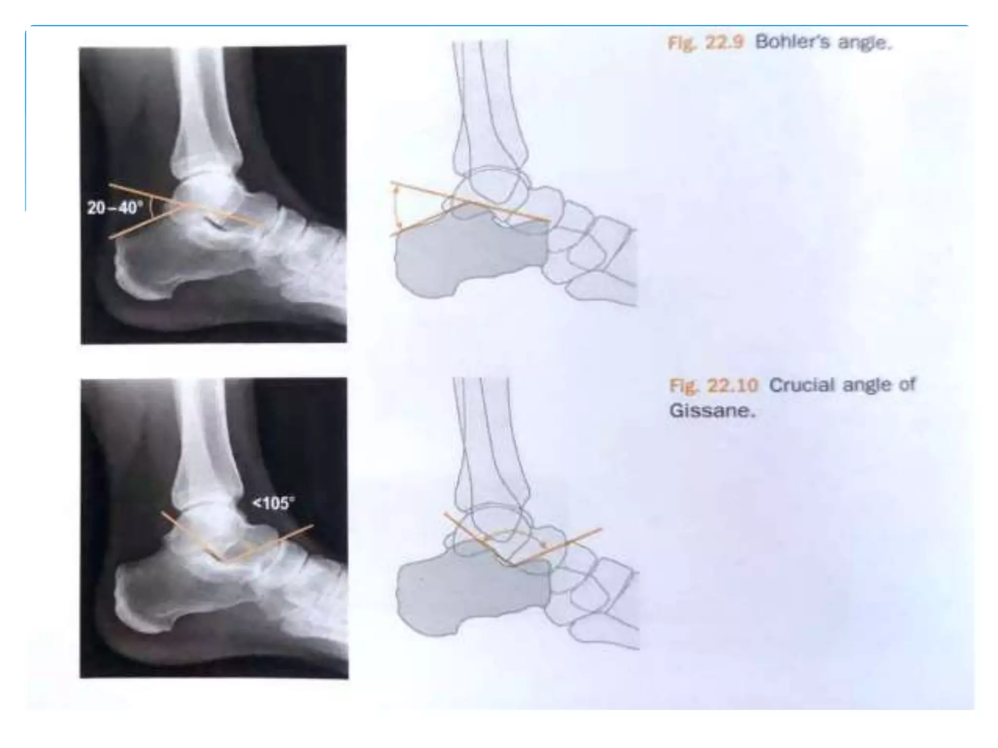CALCANEUM FRACTURES.pptx