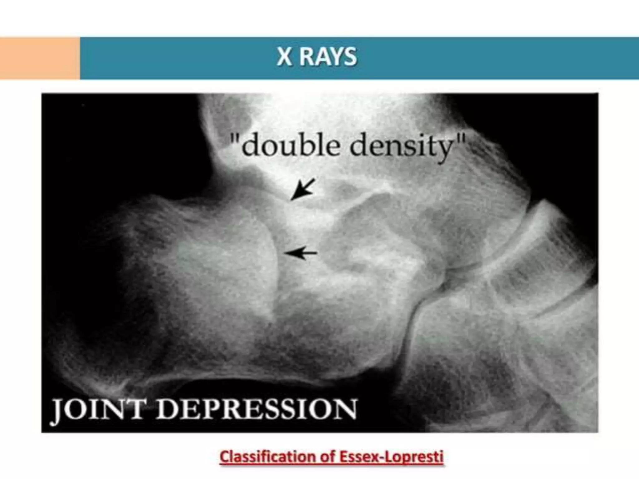 CALCANEUM FRACTURES.pptx