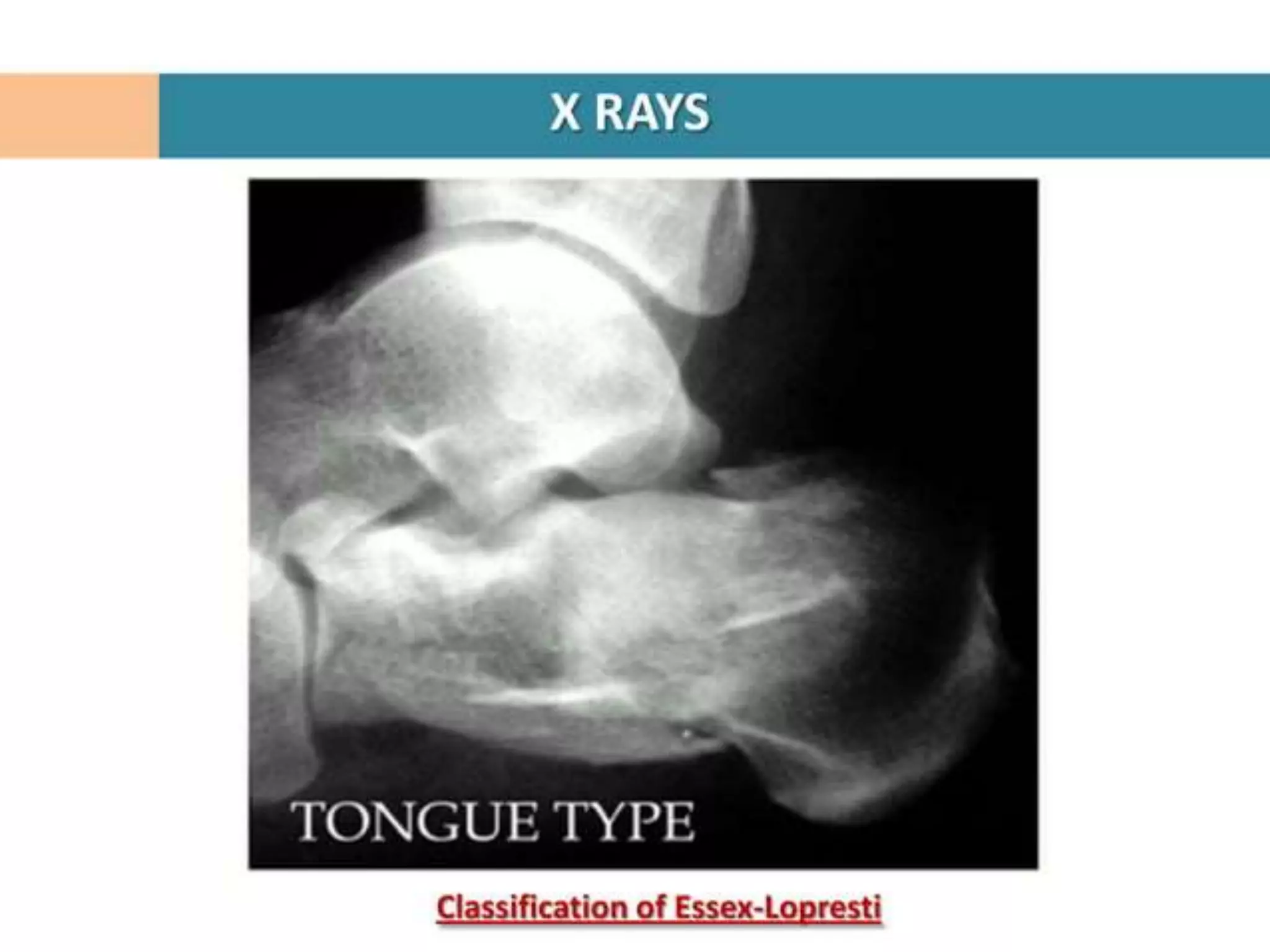 CALCANEUM FRACTURES.pptx