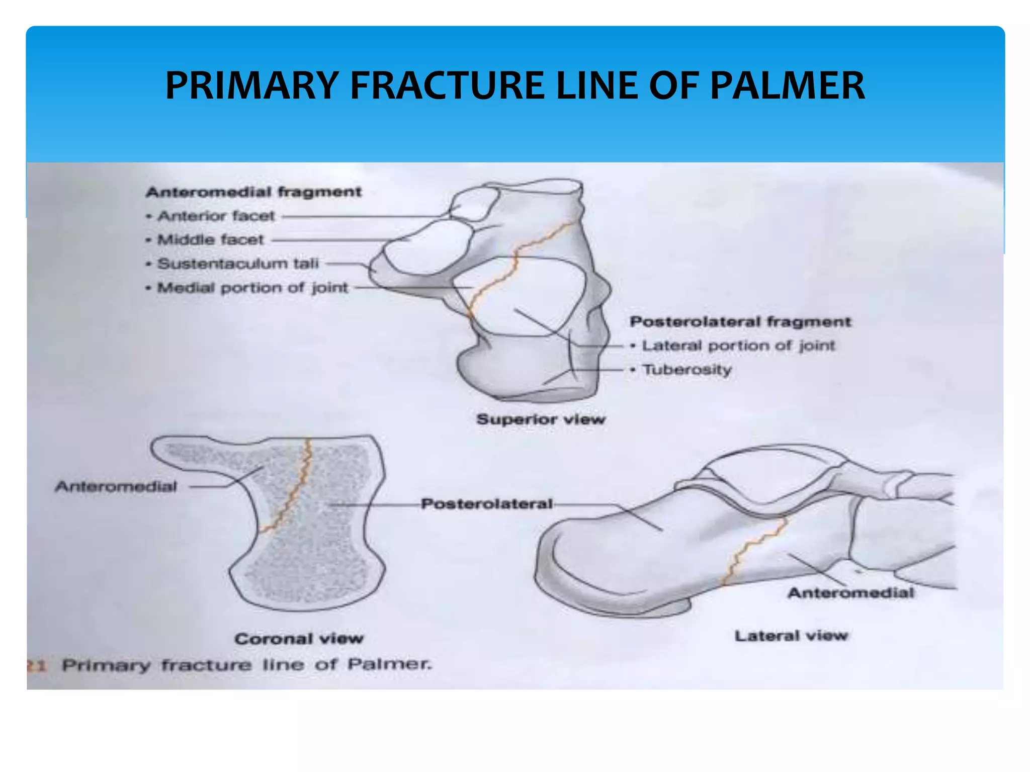 CALCANEUM FRACTURES.pptx