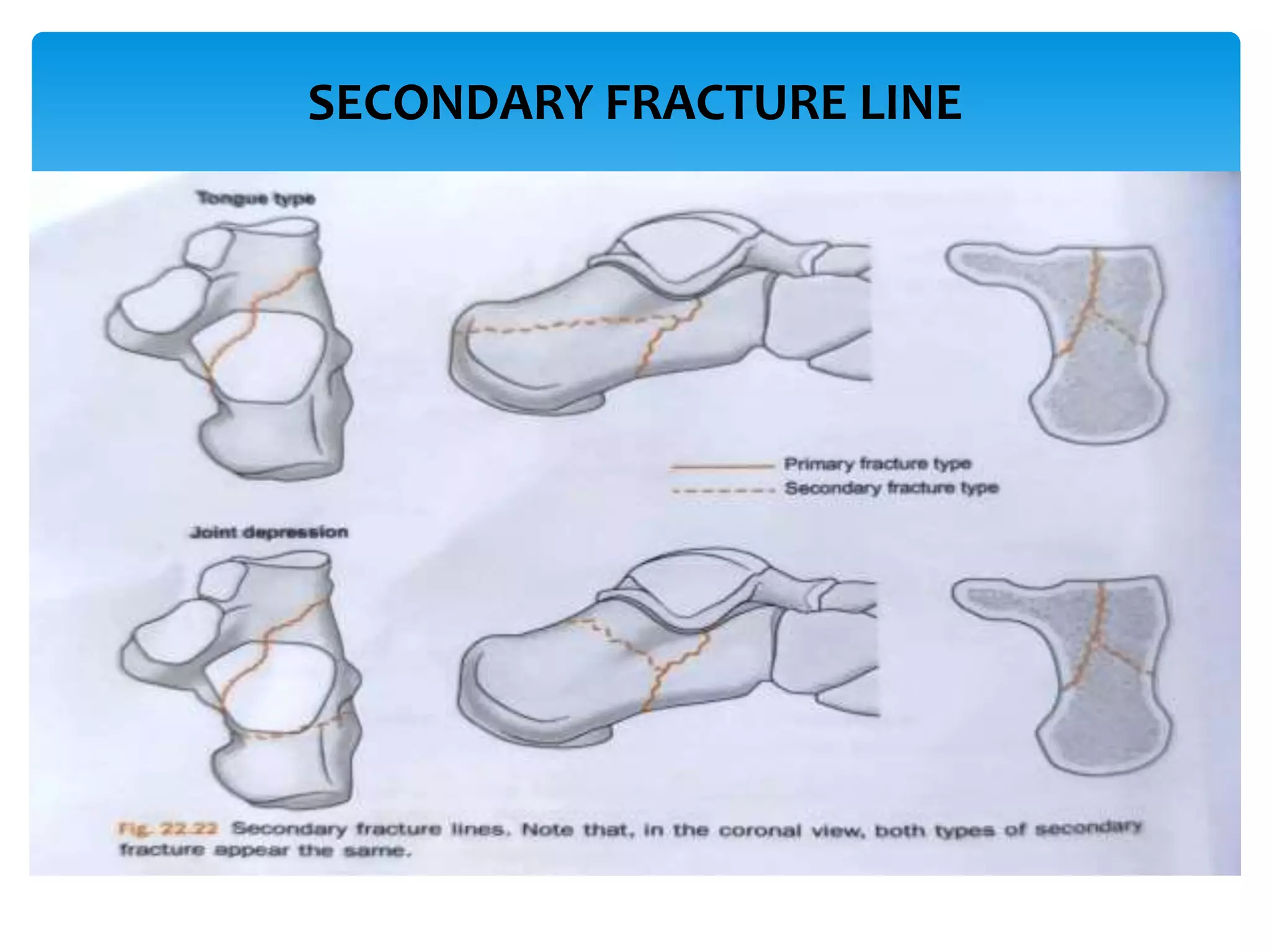 CALCANEUM FRACTURES.pptx