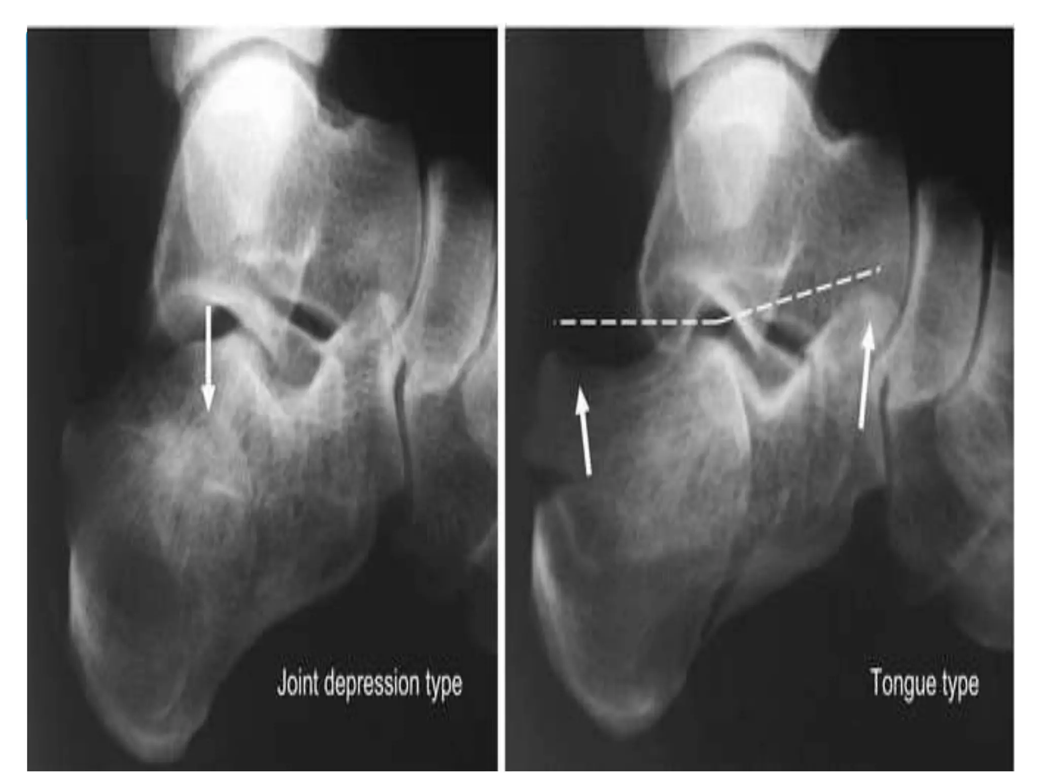 CALCANEUM FRACTURES.pptx