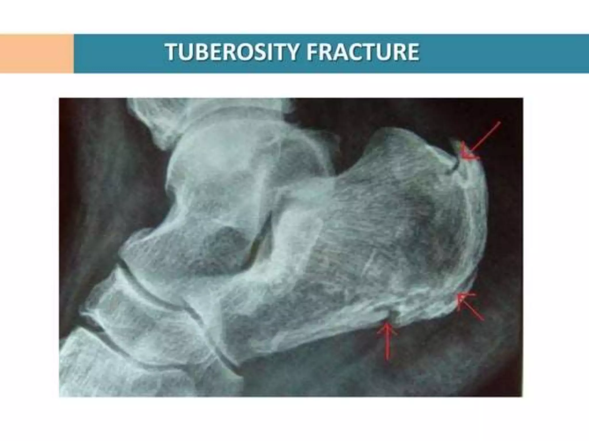 CALCANEUM FRACTURES.pptx