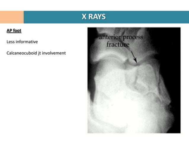 CALCANEUM FRACTURES.pptx