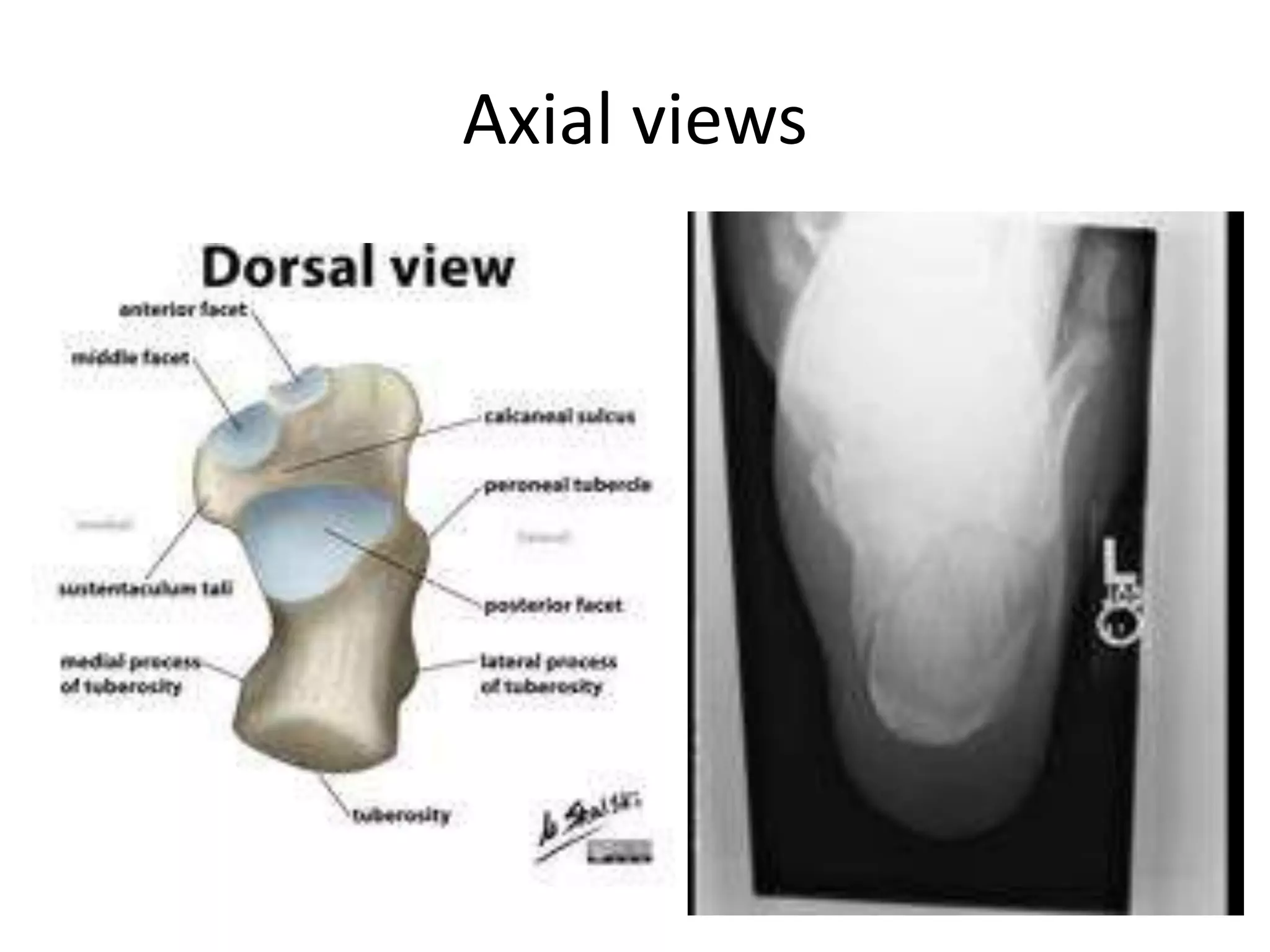 Calcaneum radiographic views | PPTX