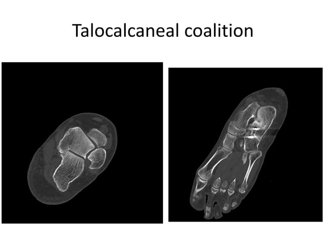 Calcaneum radiographic views | PPTX