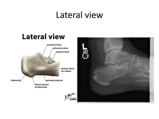 Calcaneum radiographic views | PPTX