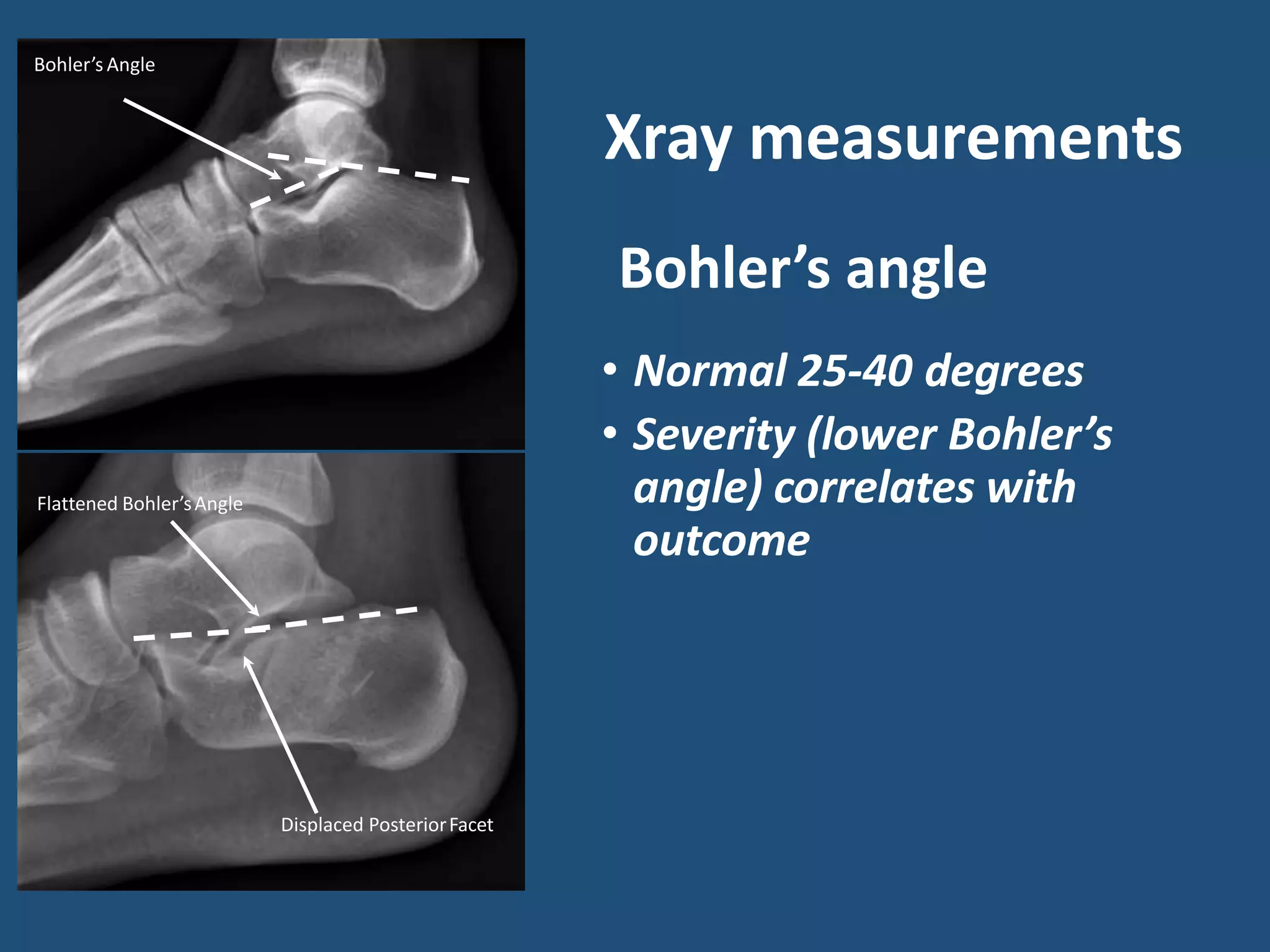 Calcaneus fracture | PPTX