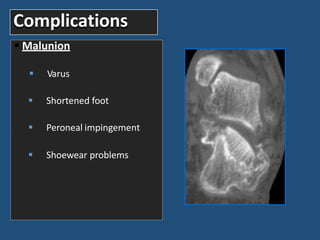 Calcaneus fracture | PPTX