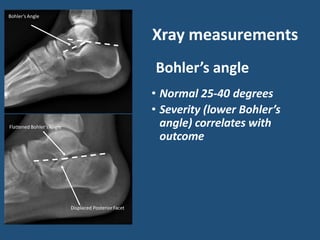 Calcaneus fracture | PPTX