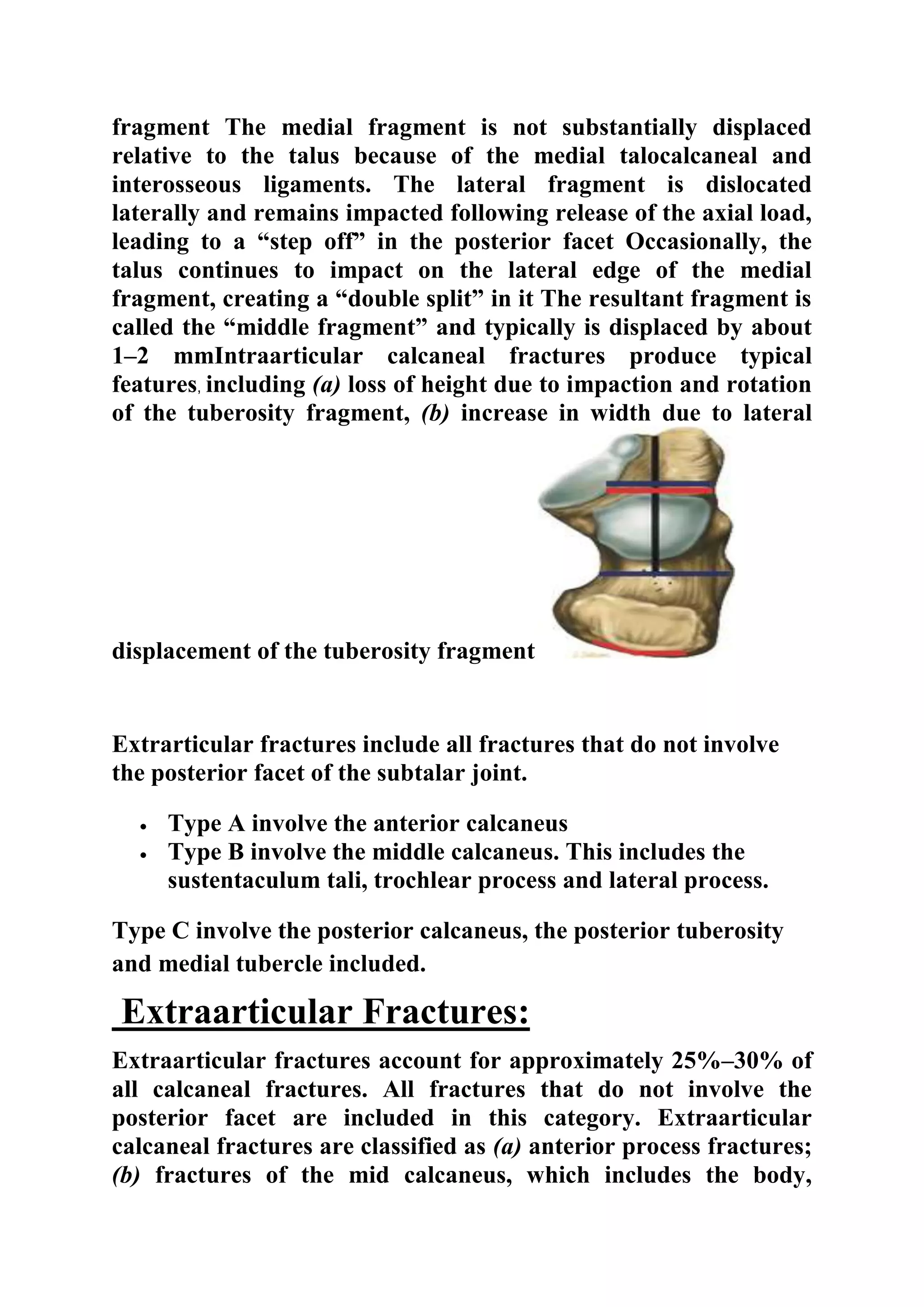 Calcaneus fracture | DOCX