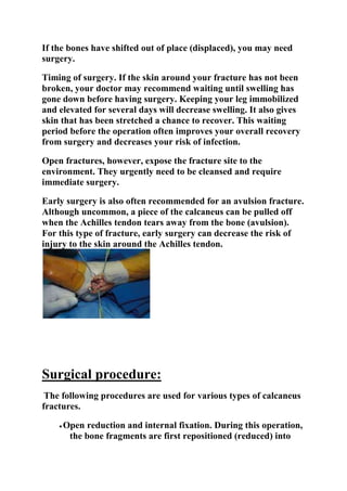 Calcaneus fracture | DOCX