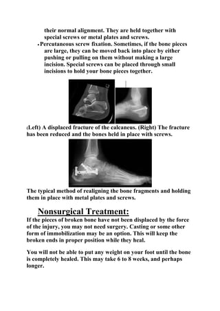 Calcaneus fracture | DOCX | Death, Injury, or Military Conflict ...
