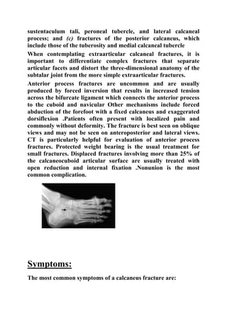 Calcaneus fracture | DOCX