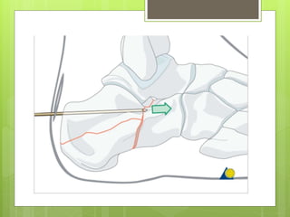 Calcaneus fracture | PPTX