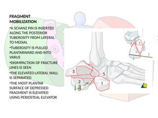 CALCANEUS FRACTURE ORIF AND COMPLICATION.pptx