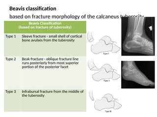 Calcaneus Fractures a brief presentation | PPTX