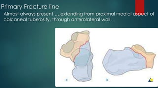 Calcaneus fractures by dr sidhu | PPTX