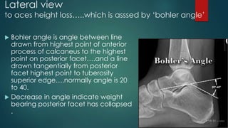 Calcaneus fractures by dr sidhu | PPTX