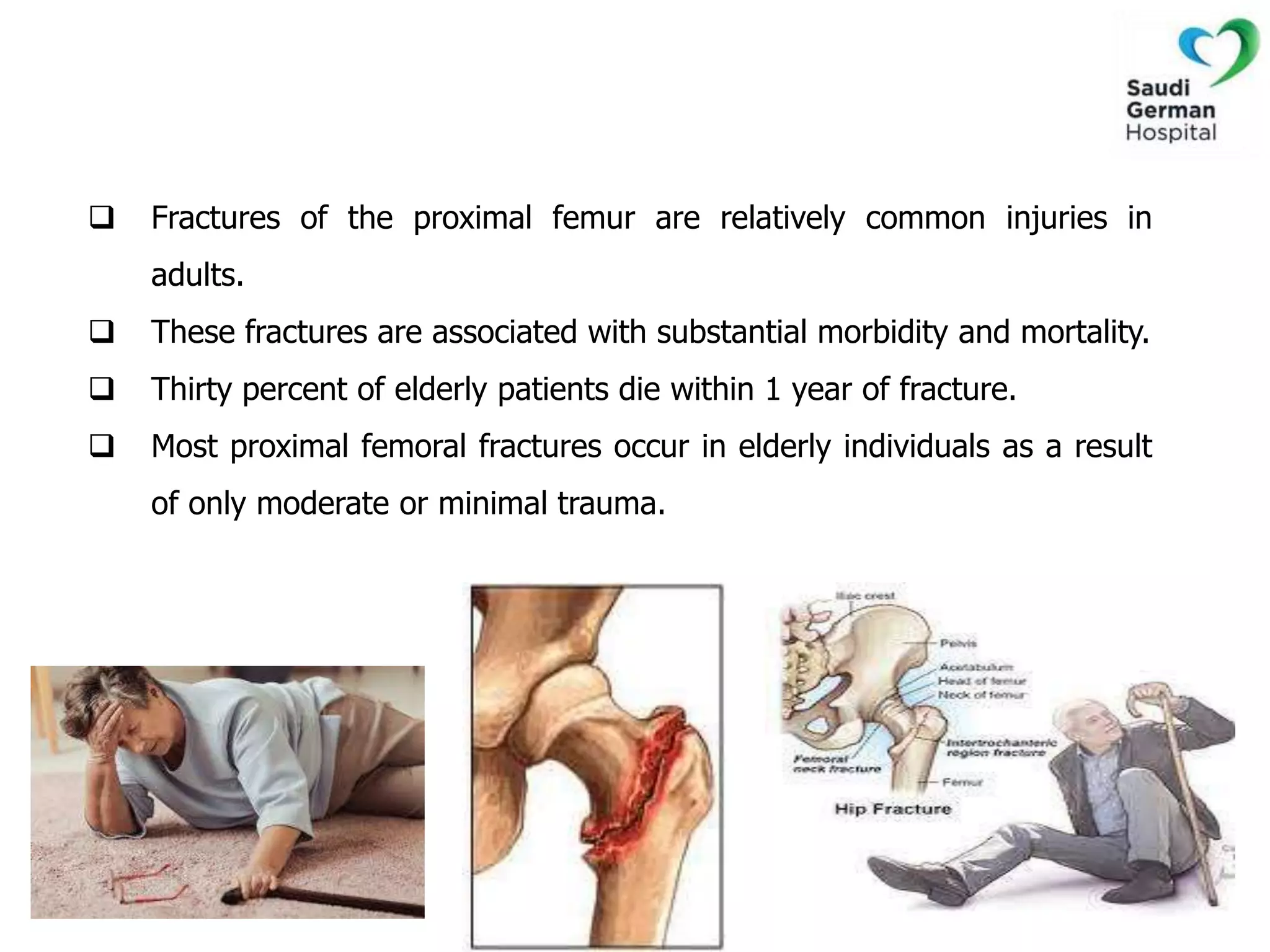 Calcar replacement arthroplasty in treatment of failed trochanteric ...