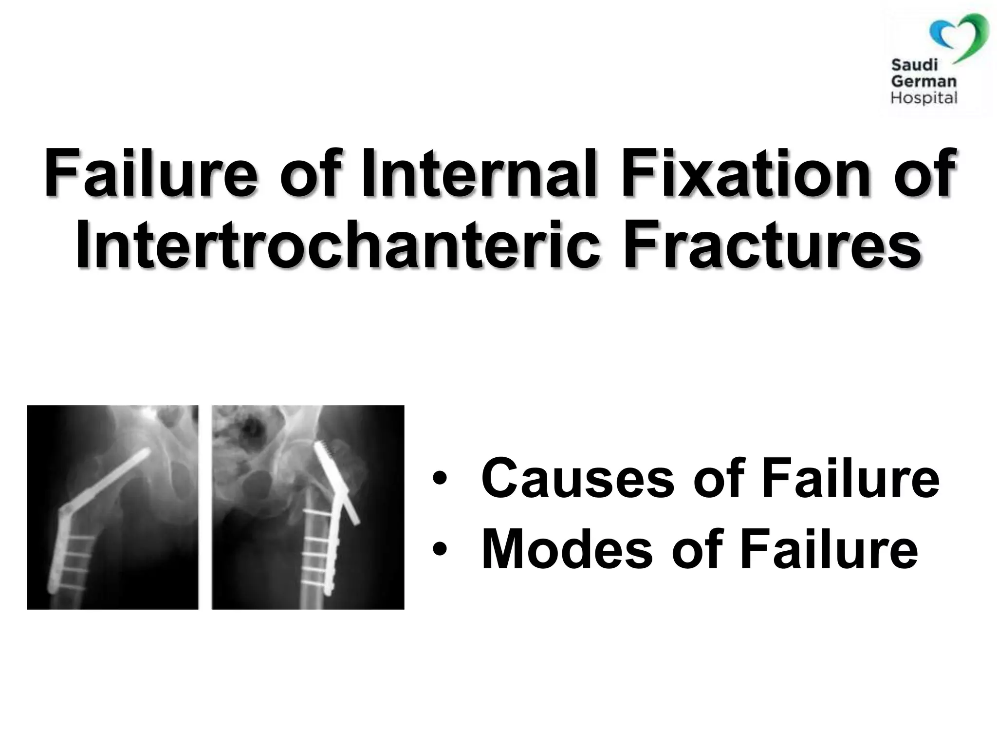 Calcar replacement arthroplasty in treatment of failed trochanteric ...