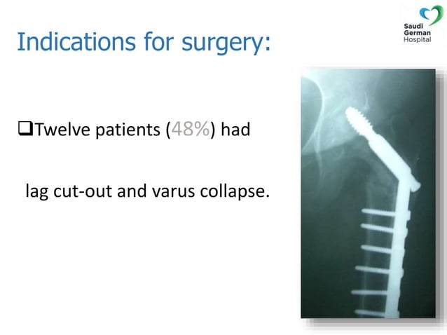 Calcar replacement arthroplasty in treatment of failed trochanteric ...