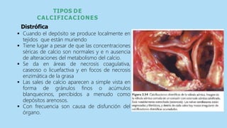CALCIFICAIONES patologia medicina ryc.pptx