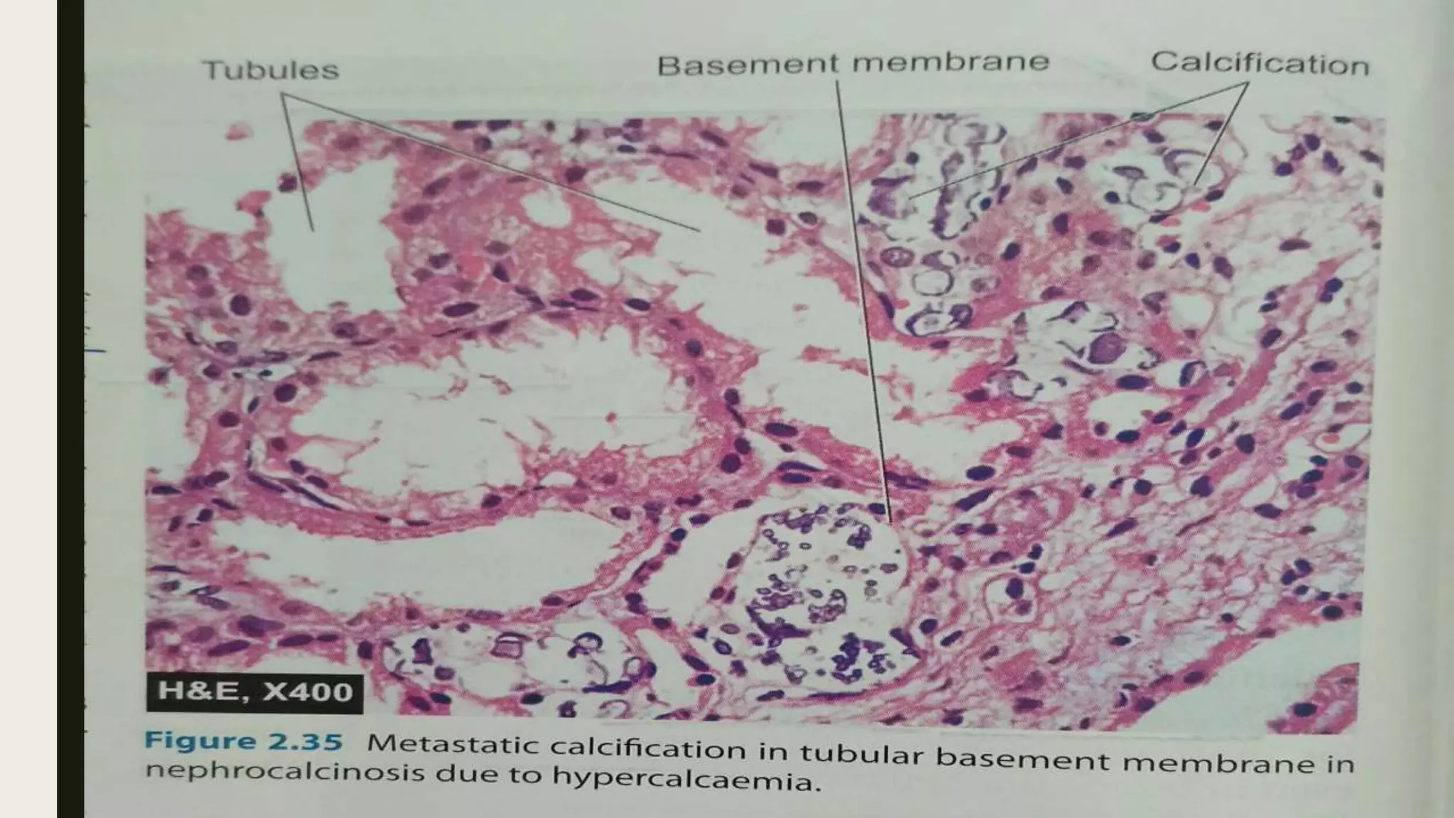 Pathologic Calcification | PPTX