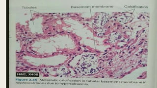 Pathologic Calcification | PPTX